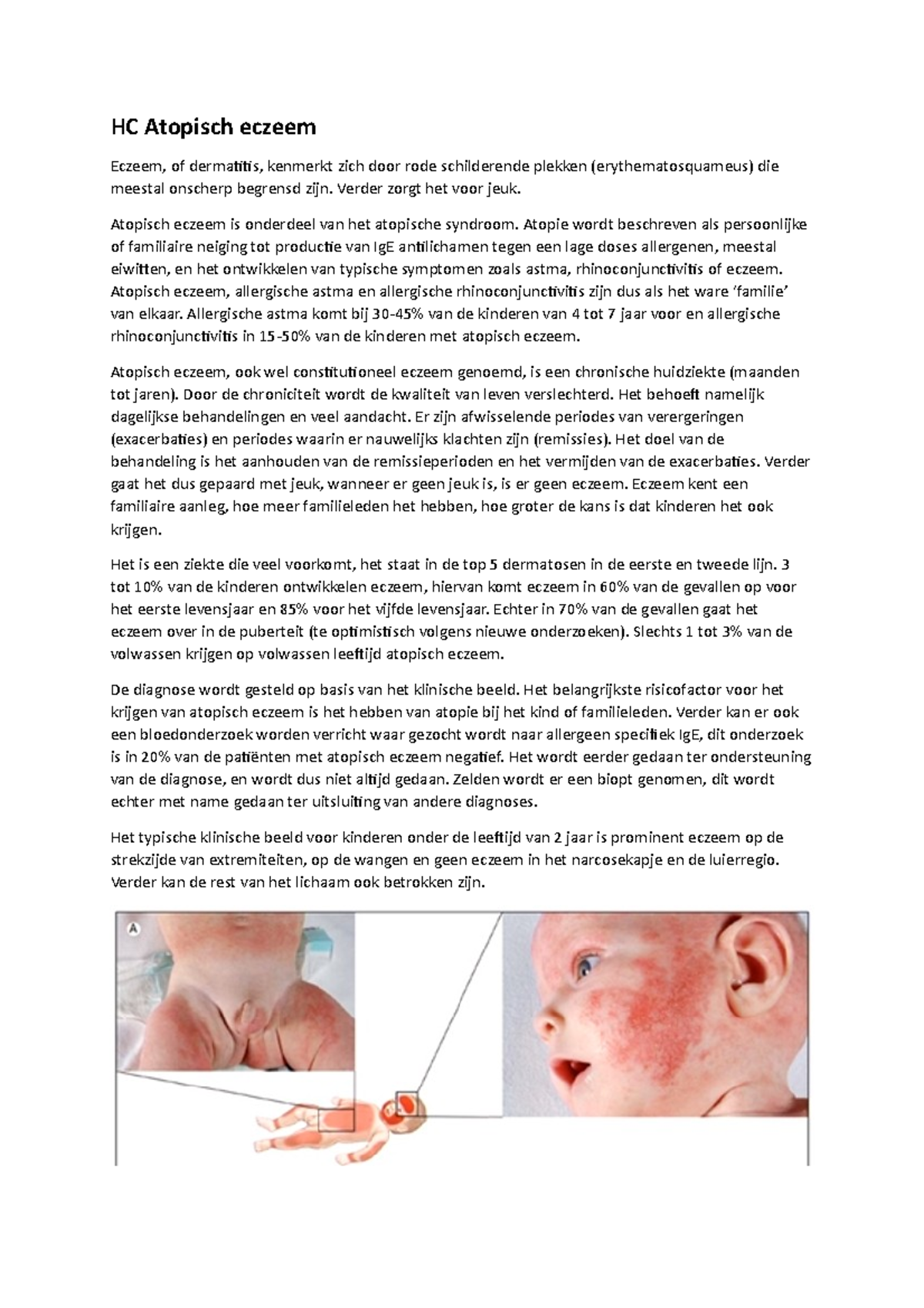 HC Atopisch eczeem - HC Atopisch eczeem Eczeem, of dermatitis, kenmerkt ...