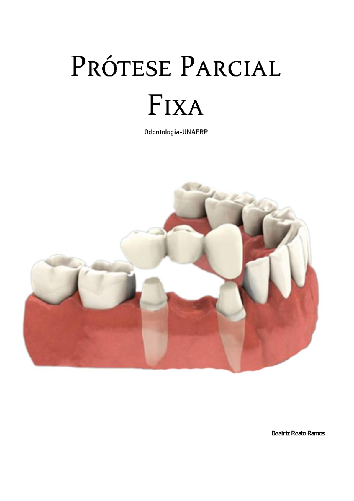 Prótese Parcial Fixa - Odontologia-UNAERP Beatriz Reato Ramos Prótese ...
