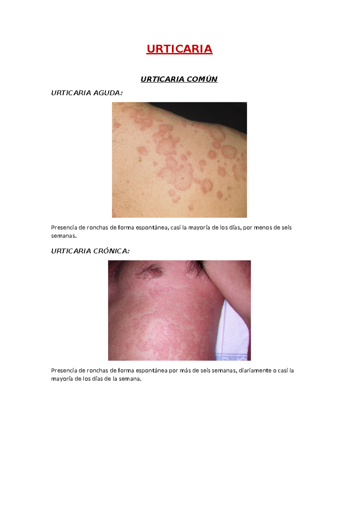 Urticaria Atlas - URTICARIA URTICARIA COMÚN URTICARIA AGUDA: Presencia ...