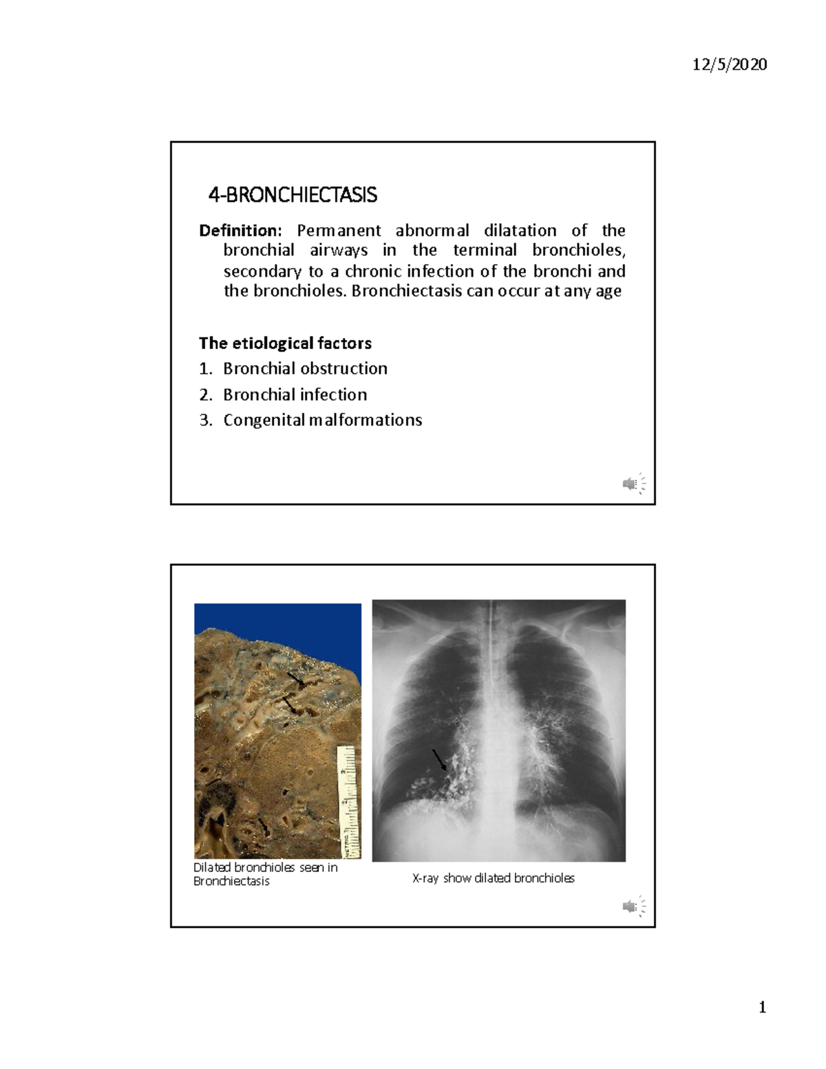 Pathology Of Lungs 2 Biochemistry Lecture 4 Bronchiectasis Definition Permanent Abnormal