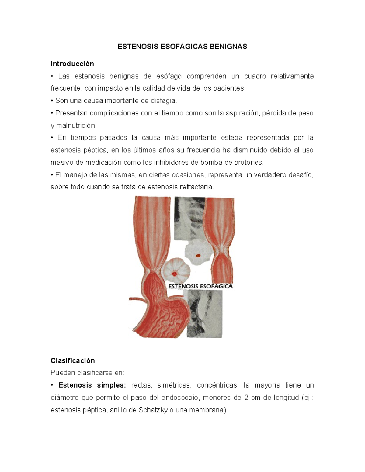 Estenosis Esofágicas Benignas - ESTENOSIS ESOFÁGICAS BENIGNAS ...