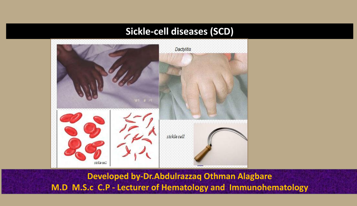 1- Sickle-cell diseases (SCD) - Sickle-cell diseases (SCD) Developed by ...