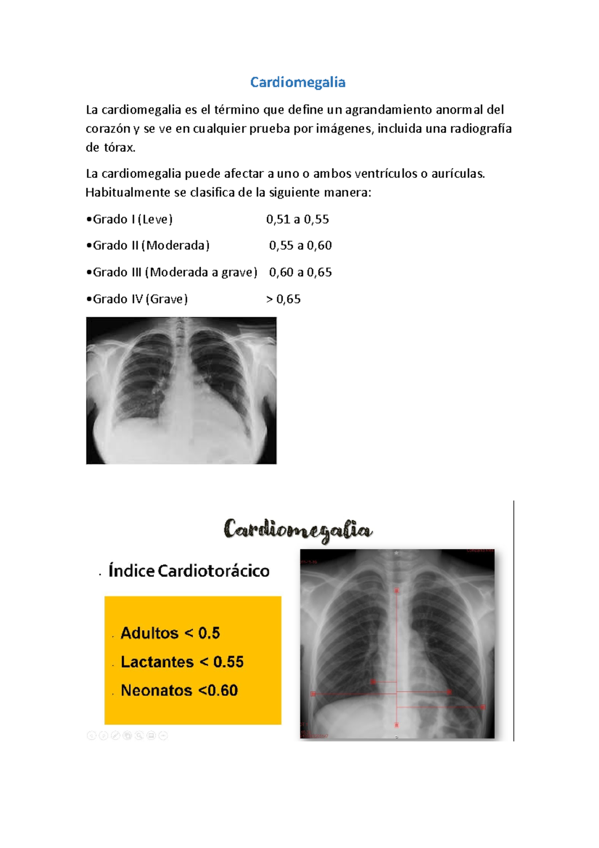 Cardiomegalia y neoplasia p - Cardiomegalia La cardiomegalia es el ...