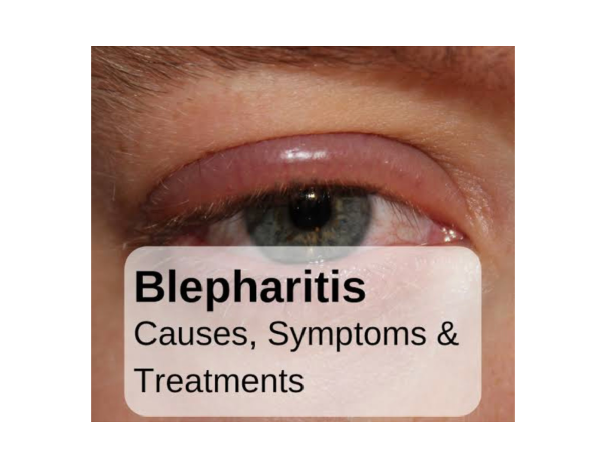 Blepharitis eye disease - Bsc.optometry - Studocu