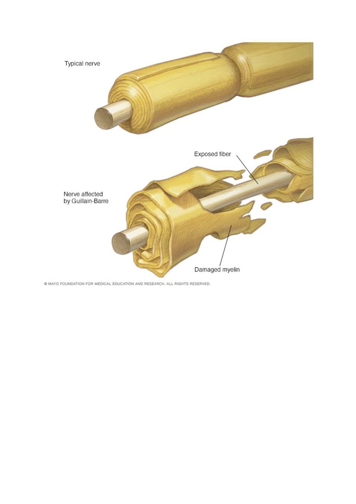 Foto syndroom - Anatomie en fysiologie - Typical nerve Exposed fiber ...