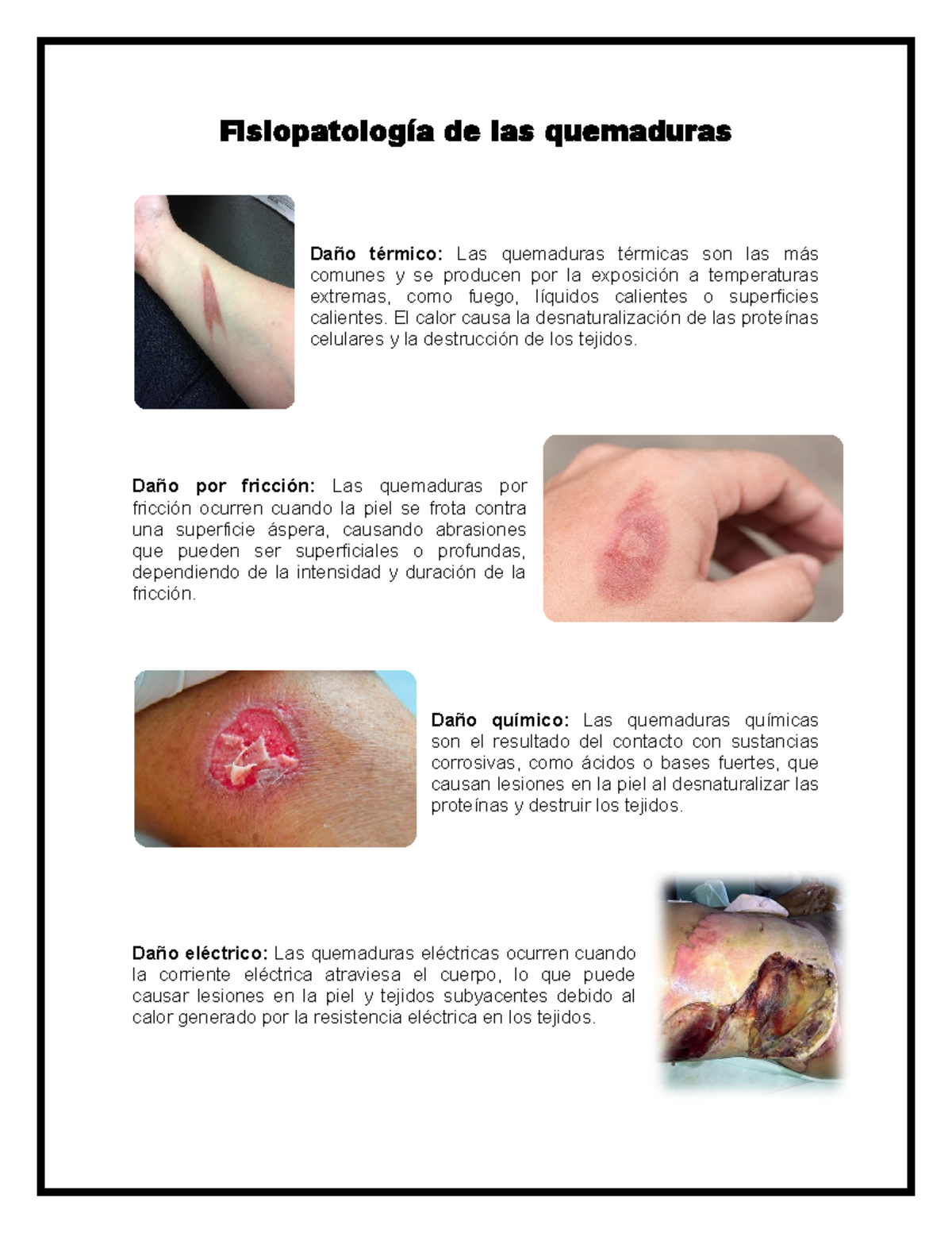 Fisiopatología de las quemaduras - Fisiopatología de las quemaduras ...