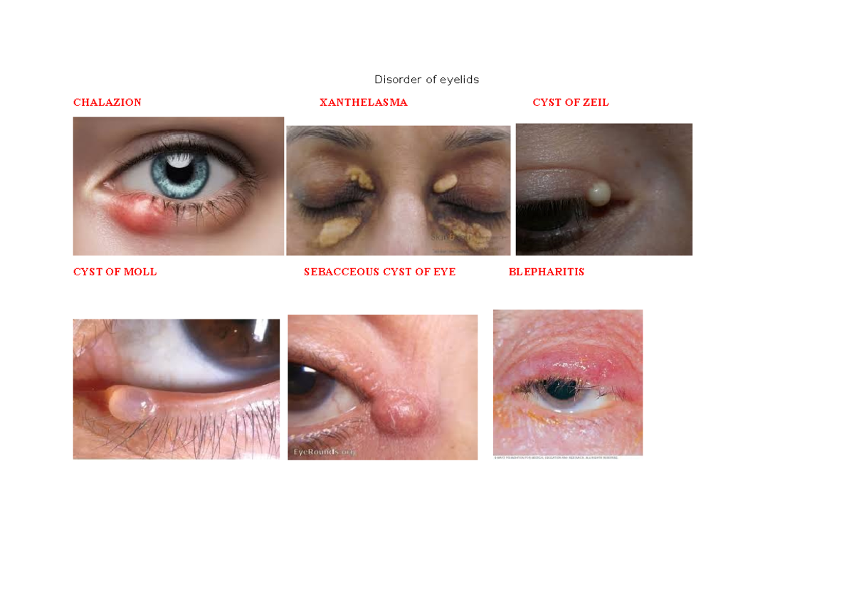 P E - notes - nursing - Disorder of eyelids CHALAZION XANTHELASMA CYST ...