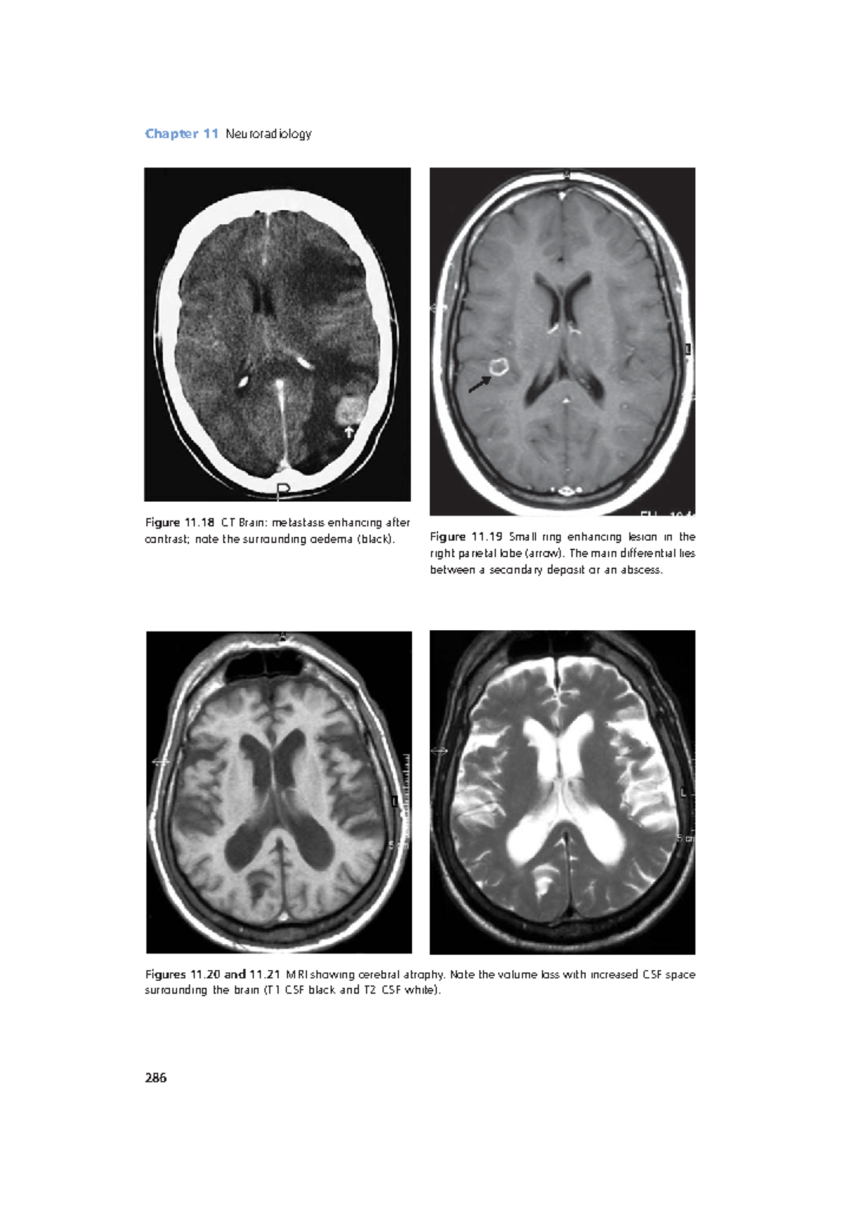 Radiology Lecture Notes pdf (96) - Chapter 11 Neuroradiology 286 Figure ...