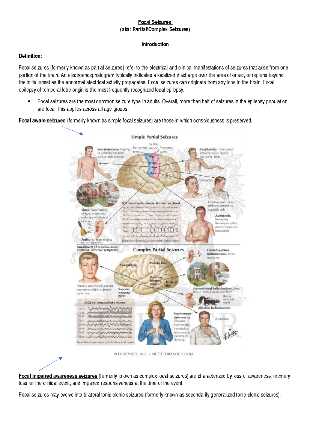 Focal Seizures (Partial Complex) - Focal Seizures (aka: Partial/Complex ...