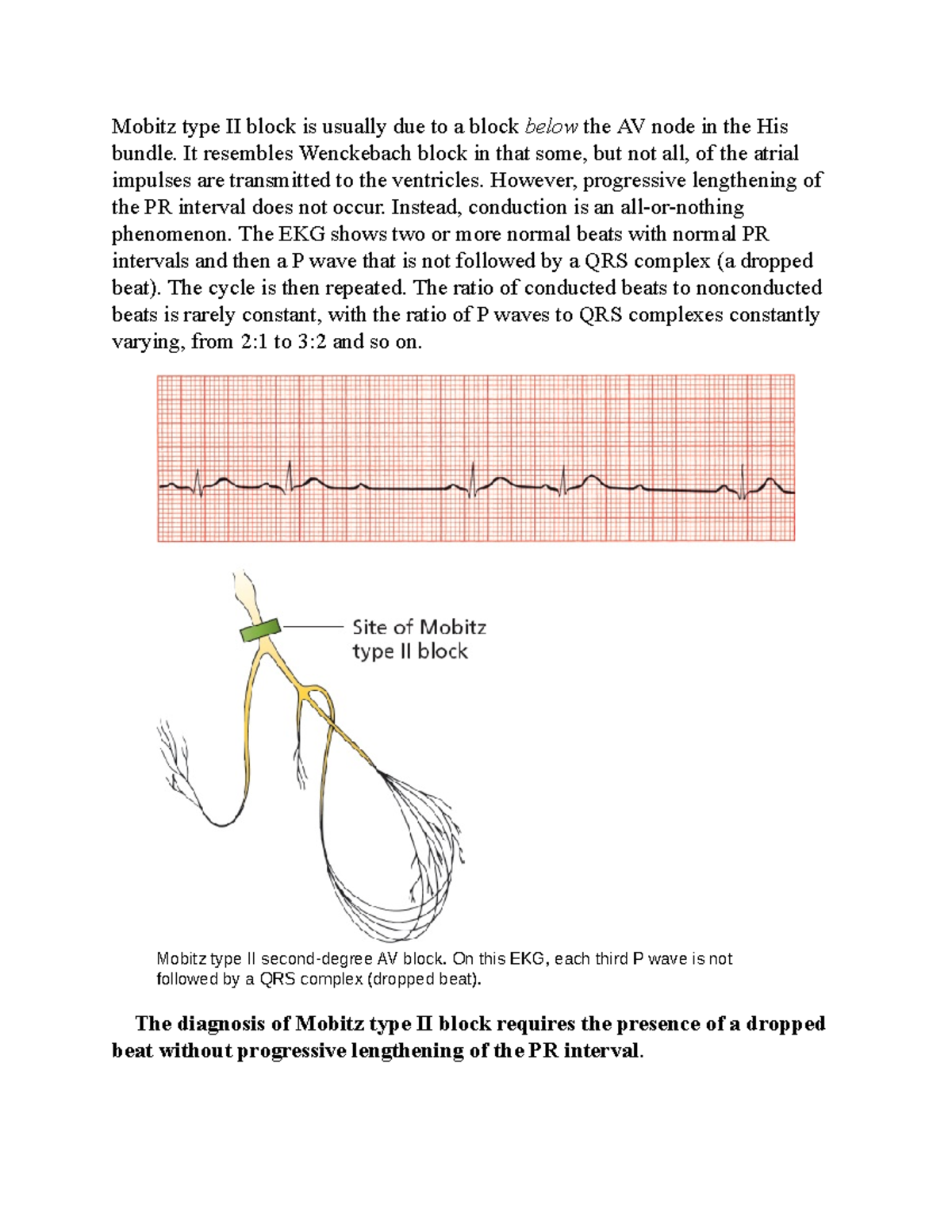 The only EKG-64 - The only EKG - Mobitz type II block is usually due to ...