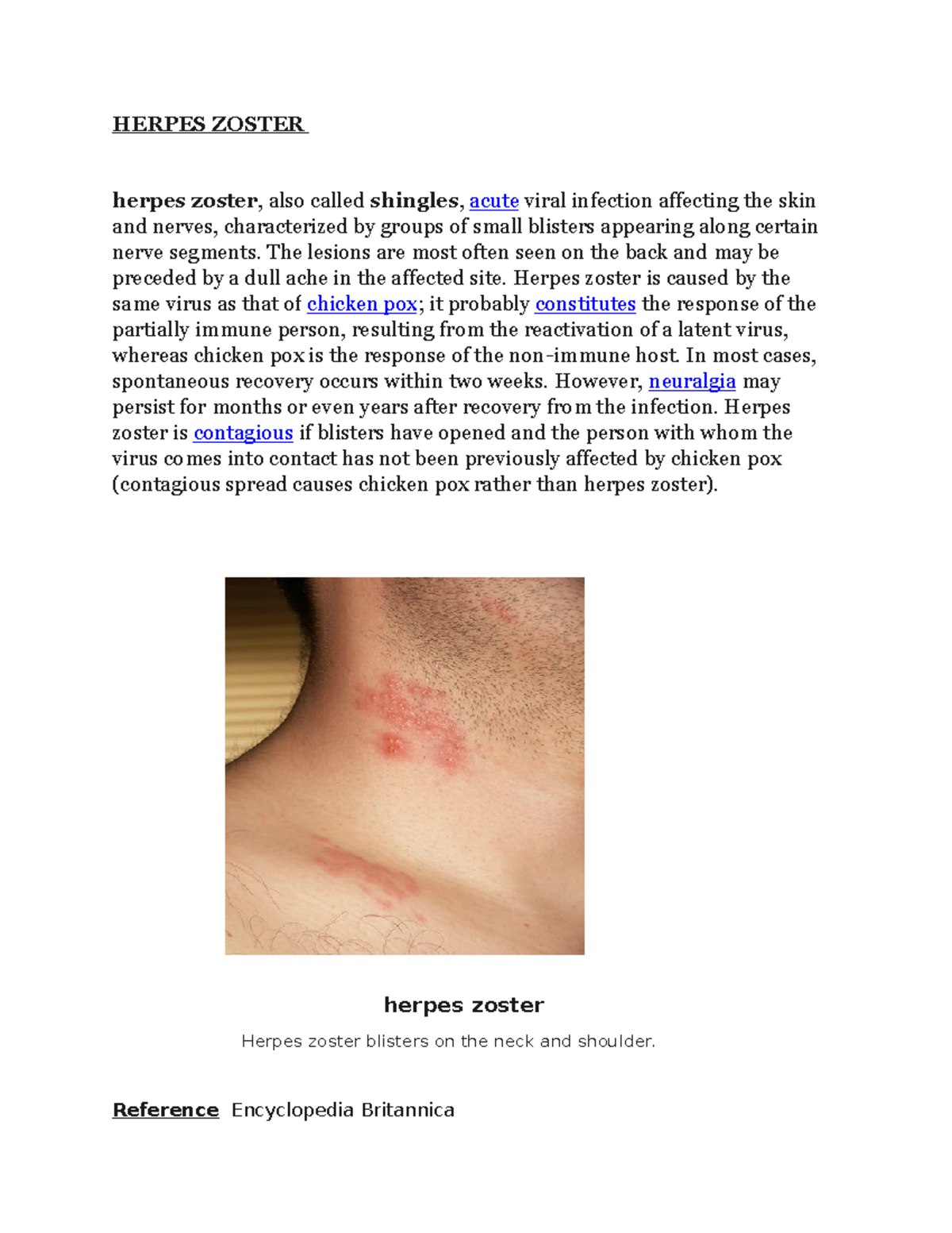 Herpes Zoster - HERPES ZOSTER herpes zoster, also called shingles ...