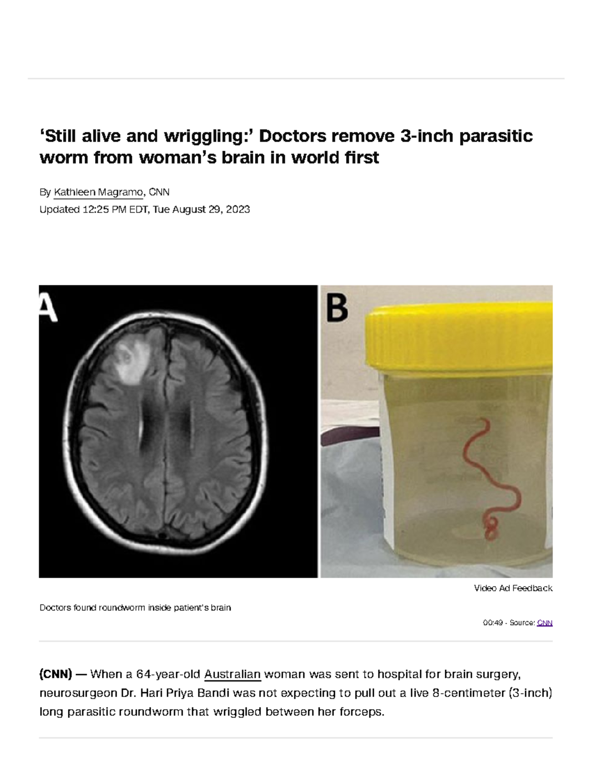 Australia Doctors remove 3-inch parasitic worm from woman's brain in ...