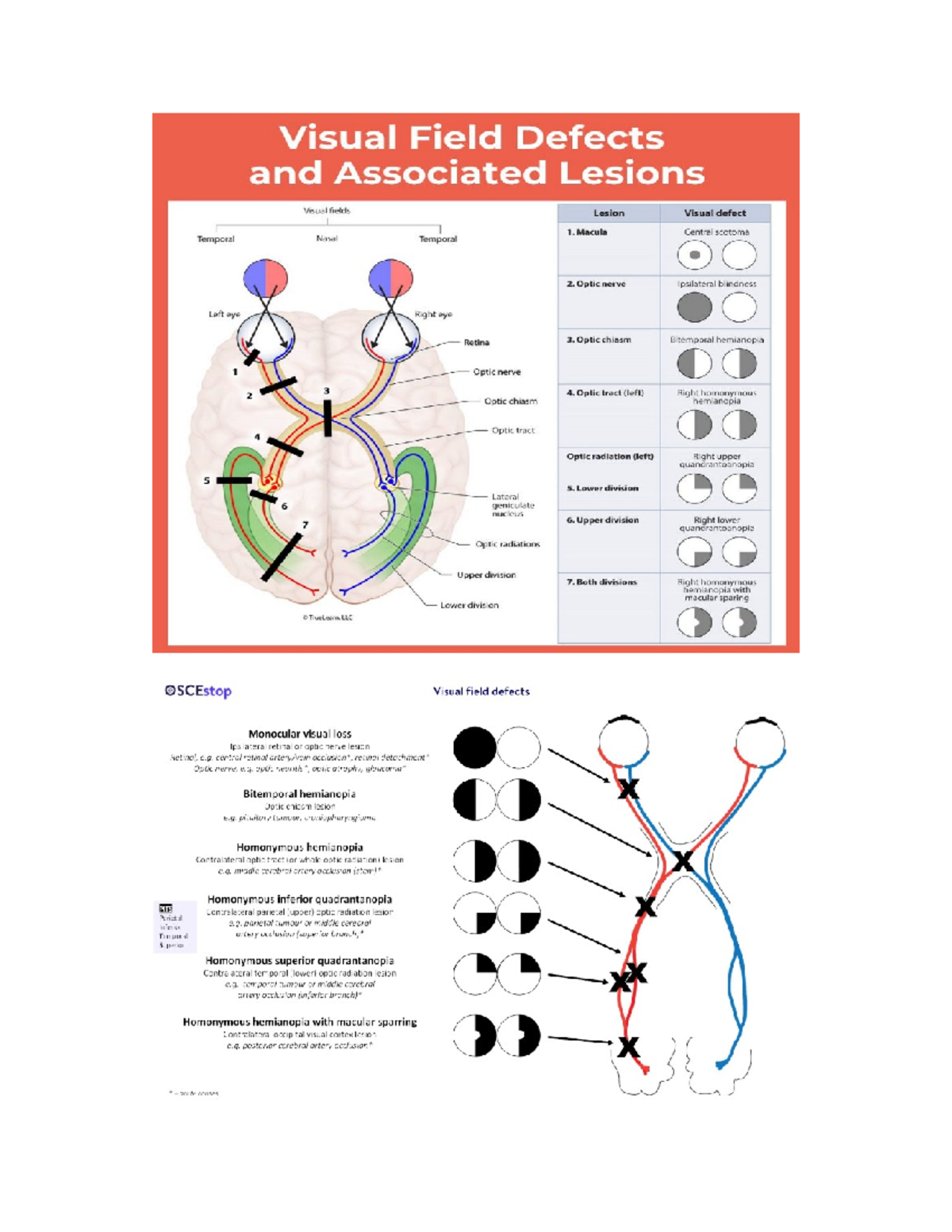 Ophthal - Visual pathway defect - Medicine - Studocu