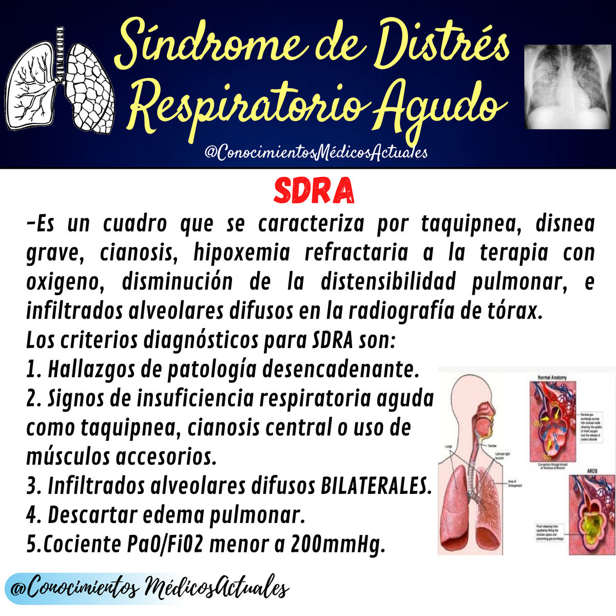 Síndrome de Distrés Respiratorio Agudo - Respiratorio Agudo -Es un ...