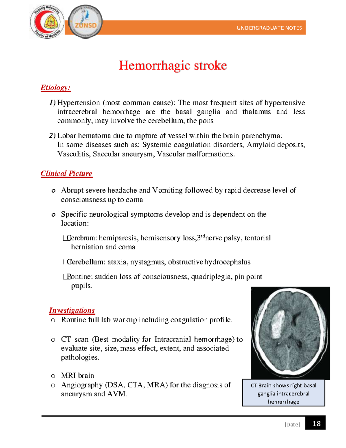 Hemorrhagic stroke - Hemorrhagic stroke Etiology: Hypertension (most ...