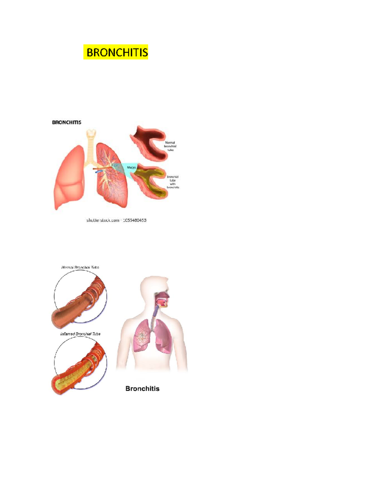 Bronchitis-WPS Office - BRONCHITIS Bronchitis is when the lining of the ...