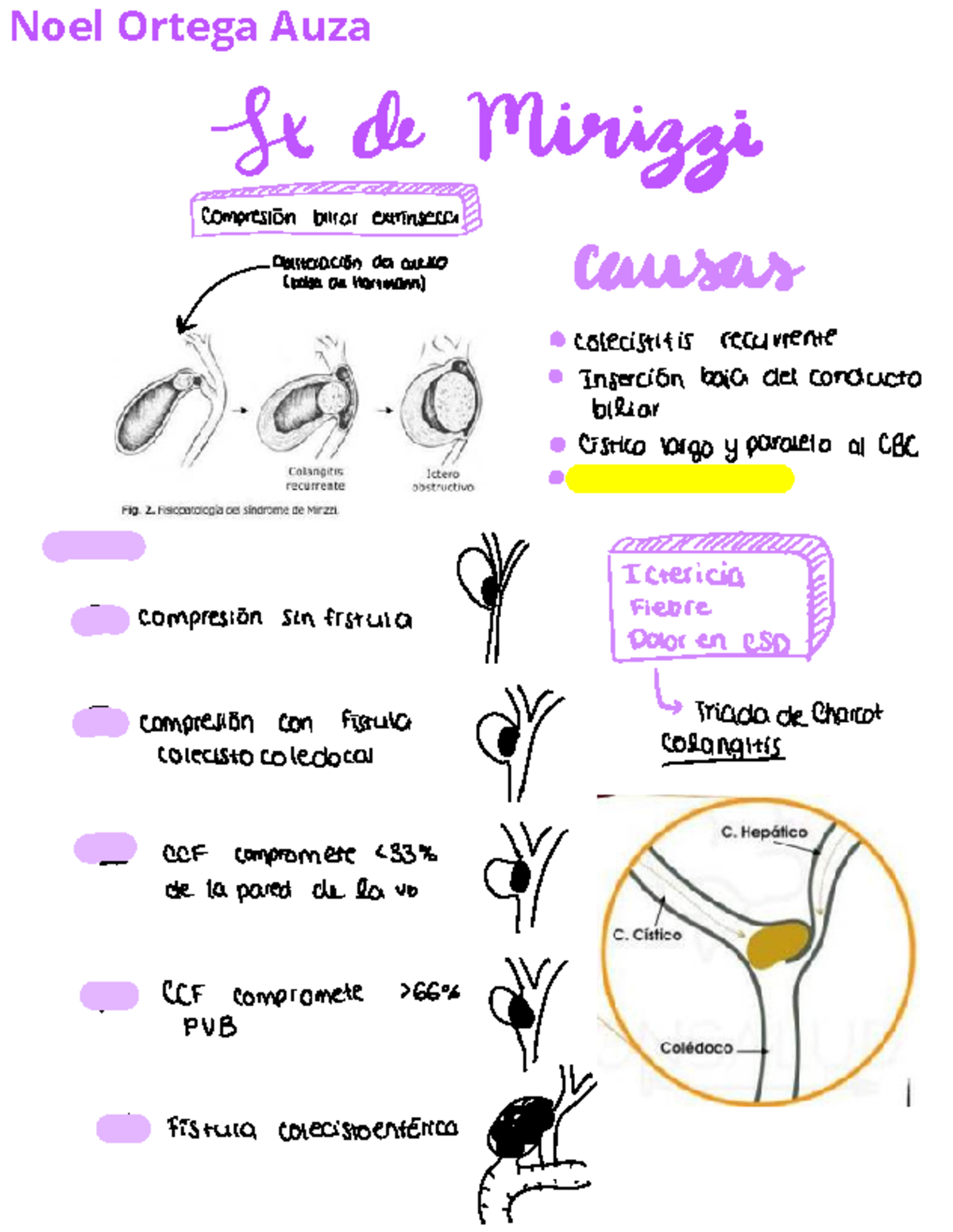 Sindrome-de-mirizzi - caso de mirizii - Noel Ortega Auza St de Mirizzi ...