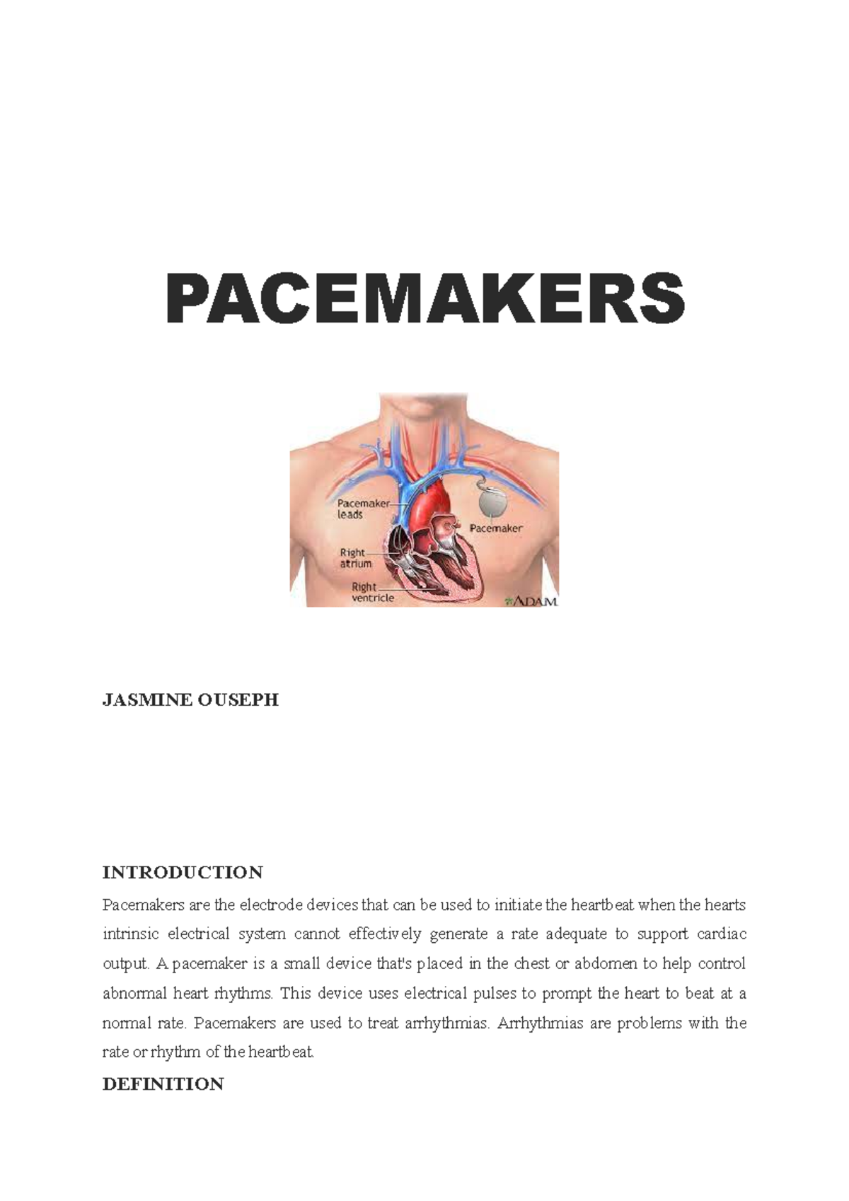 Pacemaker - JASMINE OUSEPH - PACEMAKERS JASMINE OUSEPH INTRODUCTION Pacemakers are the electrode ...
