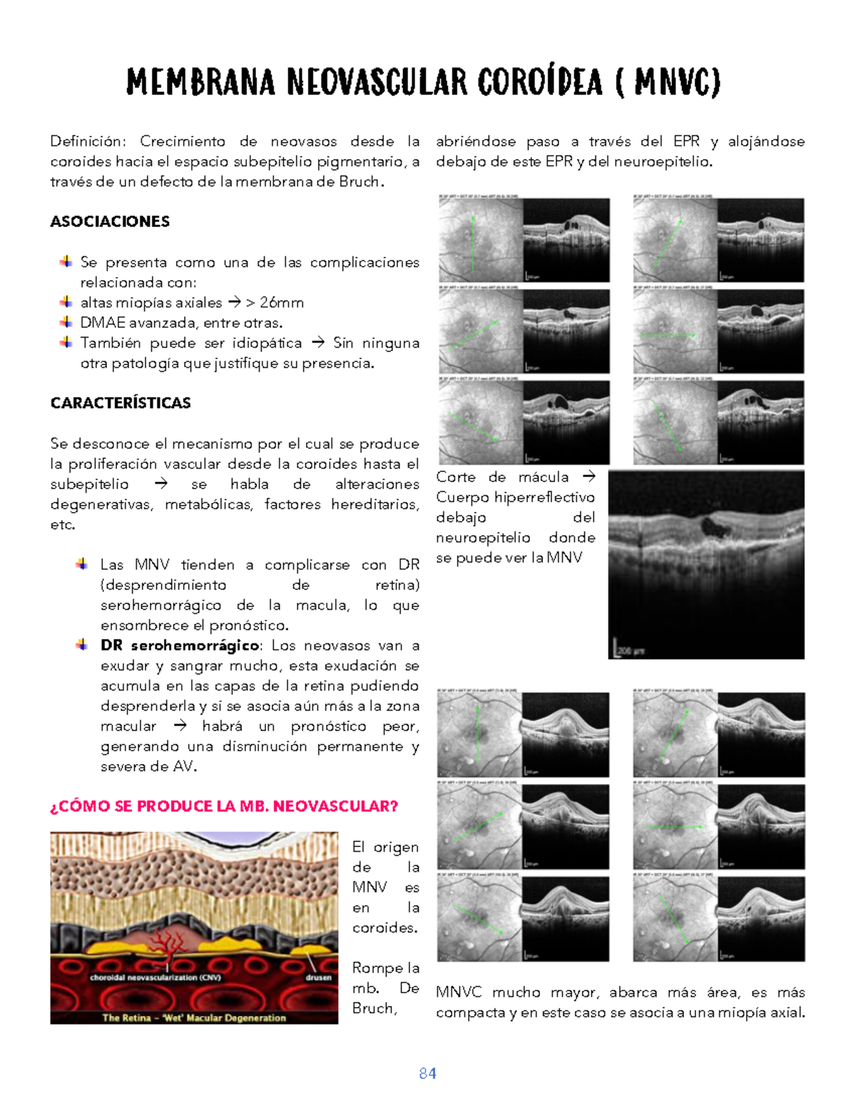 9. Membrana Neovascular Coroídea (MNVC) - Definición: Crecimiento de ...