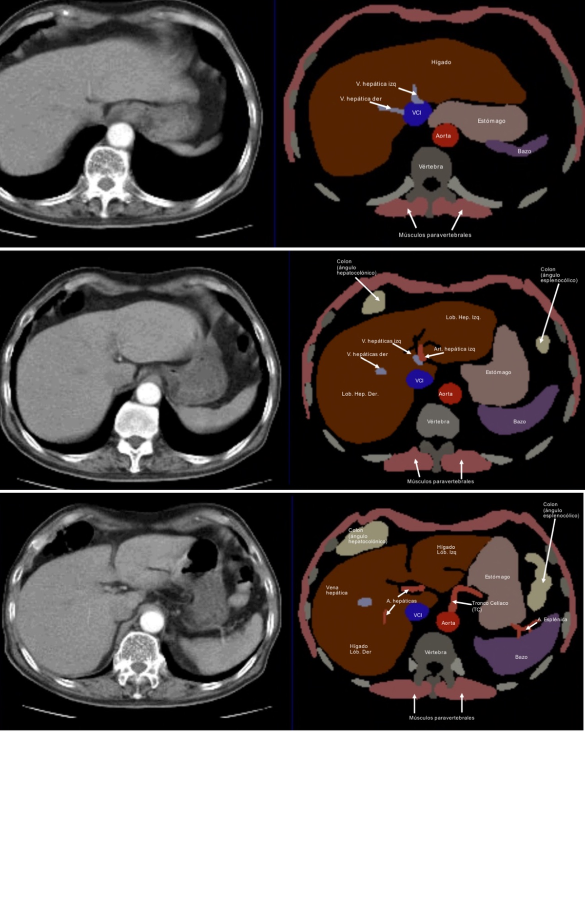 Abd Raúl - TC de abdomen - Higado V. hepática izq V. hepática der VCI ...
