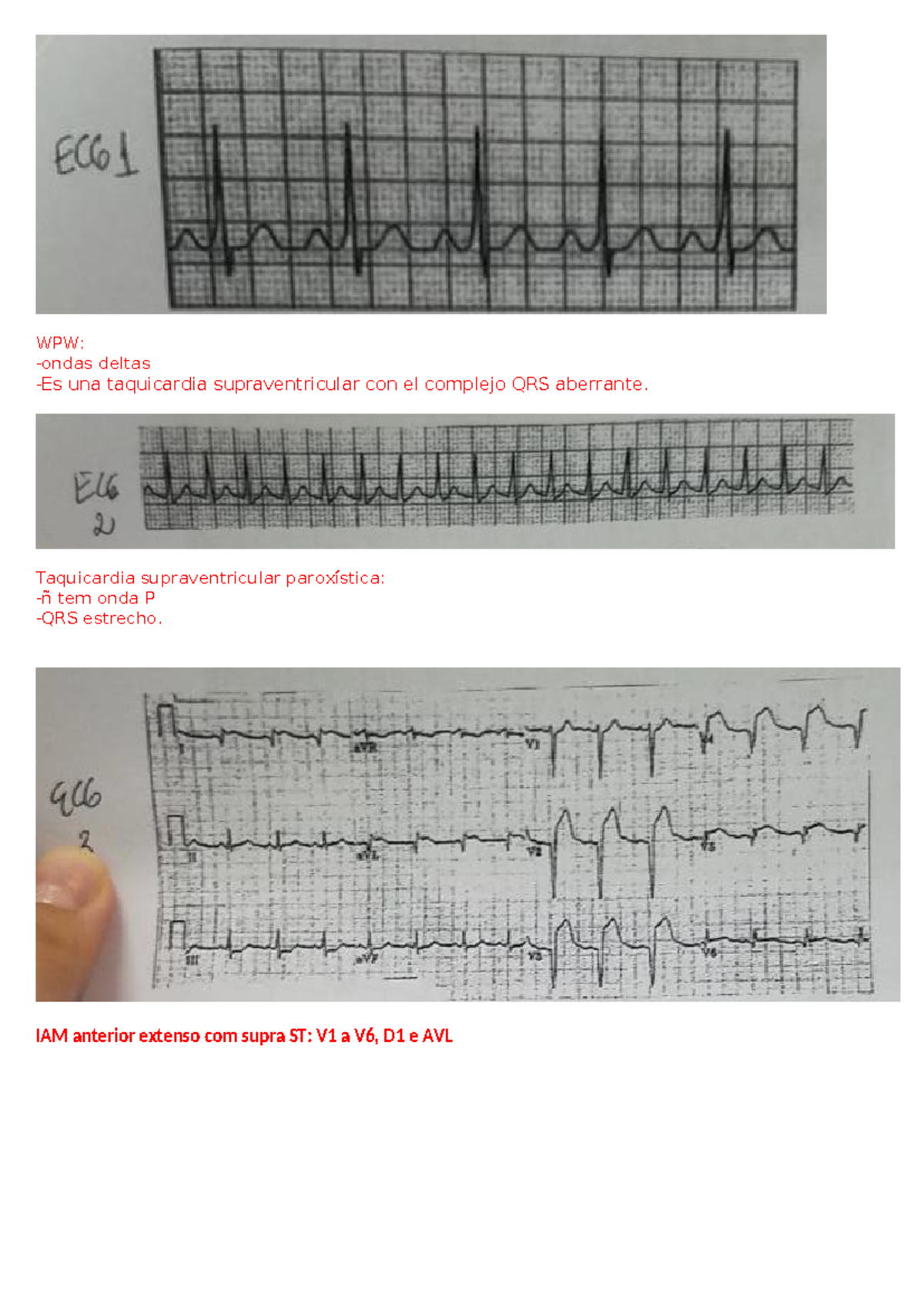 ECG Treino Interna - WPW: -ondas deltas -Es una taquicardia ...