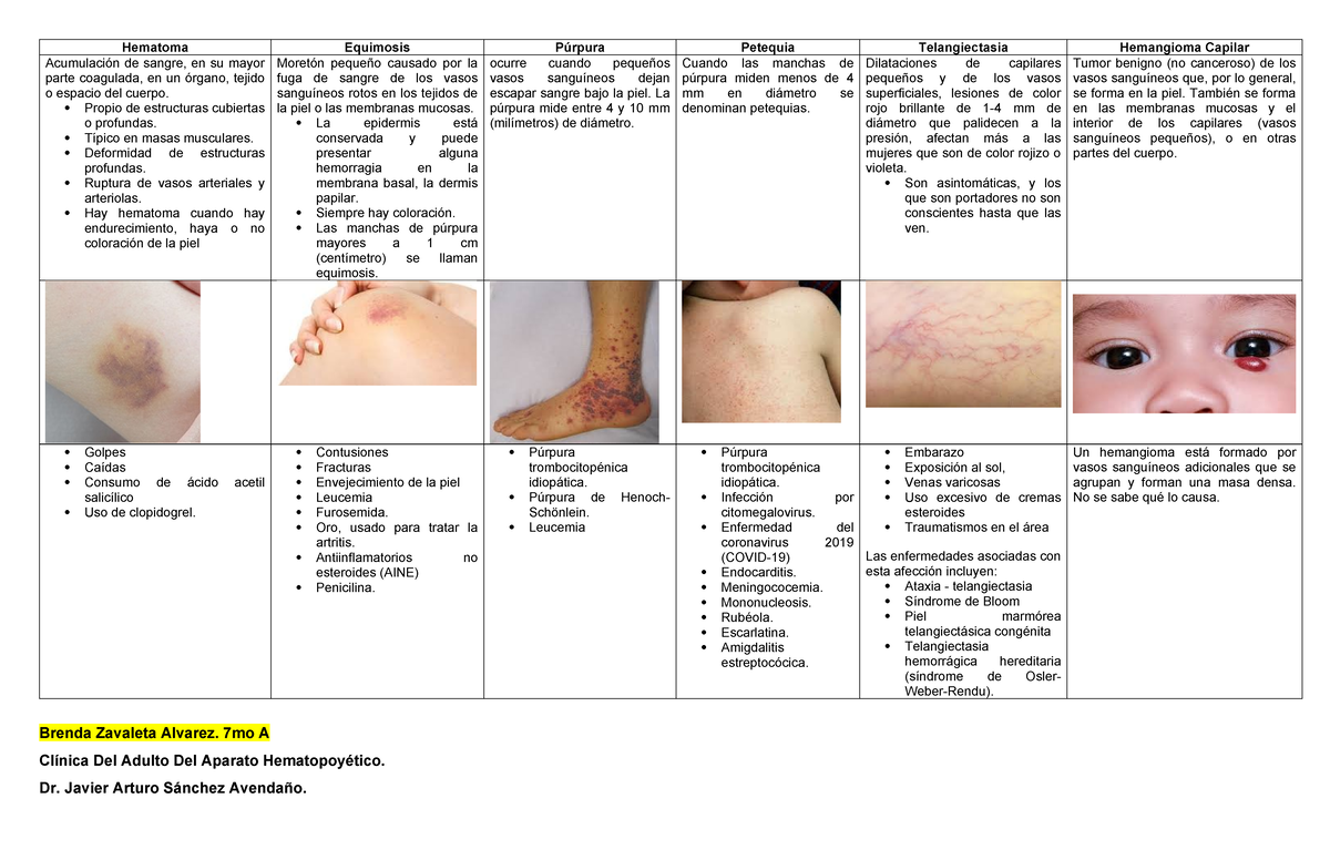 Tabloide Hemato - Hematoma Equimosis Púrpura Petequia Telangiectasia ...