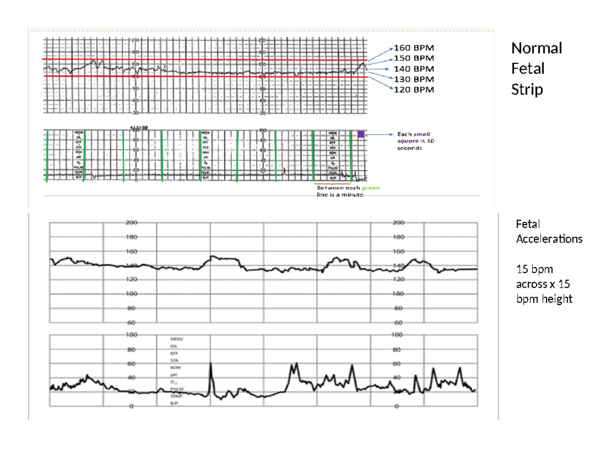 Fetal Strips - NUR 254 - Normal Fetal Strip Fetal Accelerations 15 bpm ...