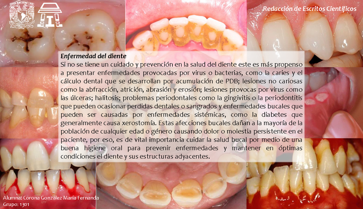 Enfermedad DEL Diente - Enfermedad del diente Si no se tiene un cuidado ...