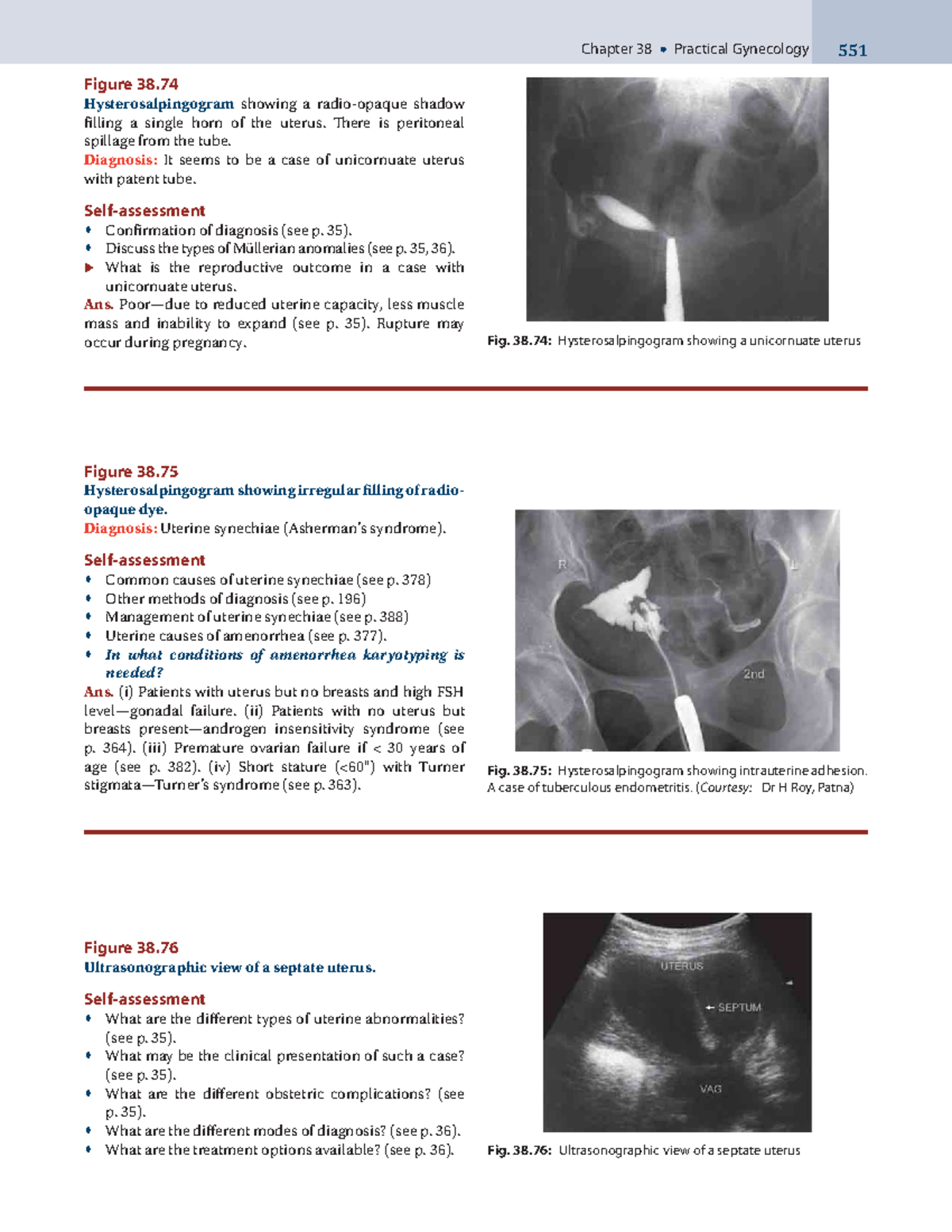 4. Dutta'ss Textbook of Gynecology -Lecture Notes - Chapter 38 ...