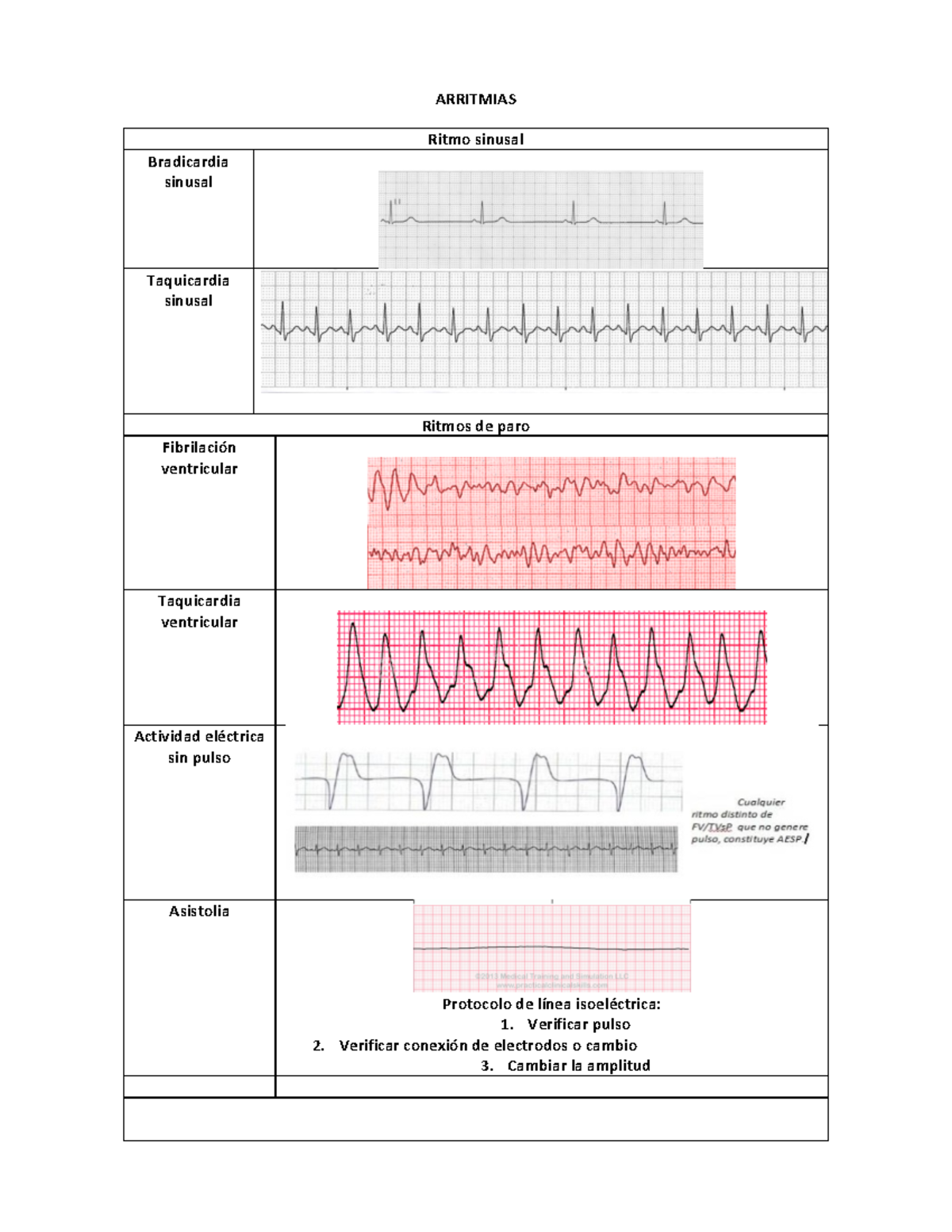 Arritmias Todas - ARRITMIAS Ritmo sinusal Bradicardia sinusal Taquicardia sinusal Ritmos de paro ...