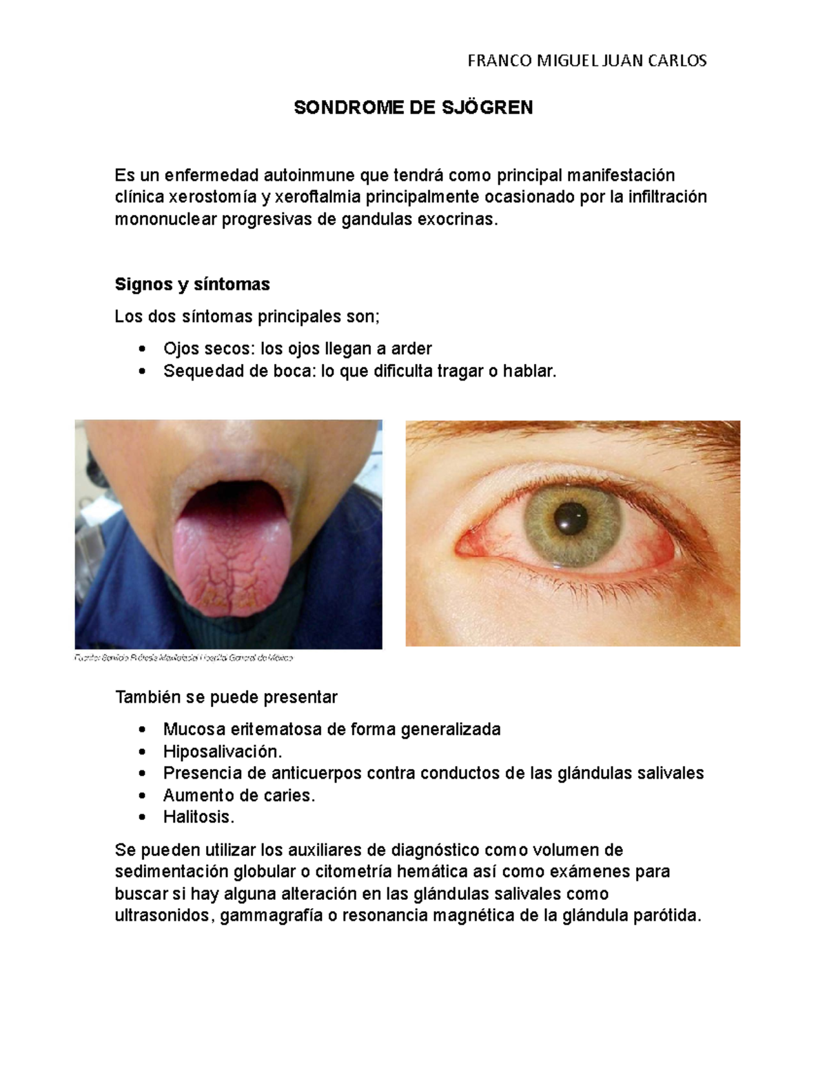 Sondrome DE Sjögren - SINDROME DE SJOGREN - FRANCO MIGUEL JUAN CARLOS SONDROME DE SJÖGREN Es un ...