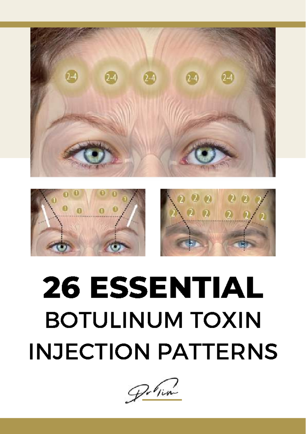 26 Essential Botulinum Toxin Injection Patterns - BOTULINUM TOXIN ...