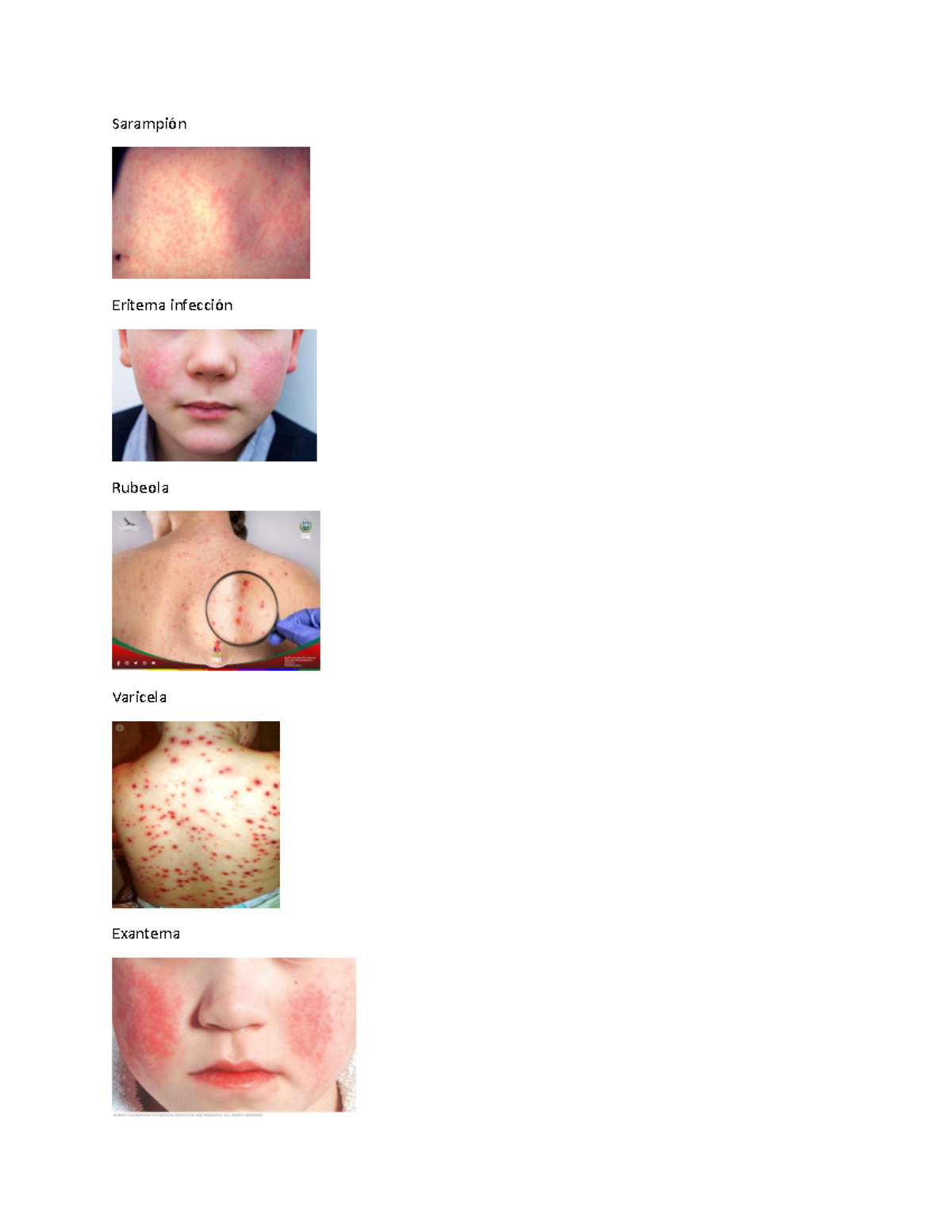 Parvovirus - Microbiología I - Sarampión Eritema infección Rubeola ...