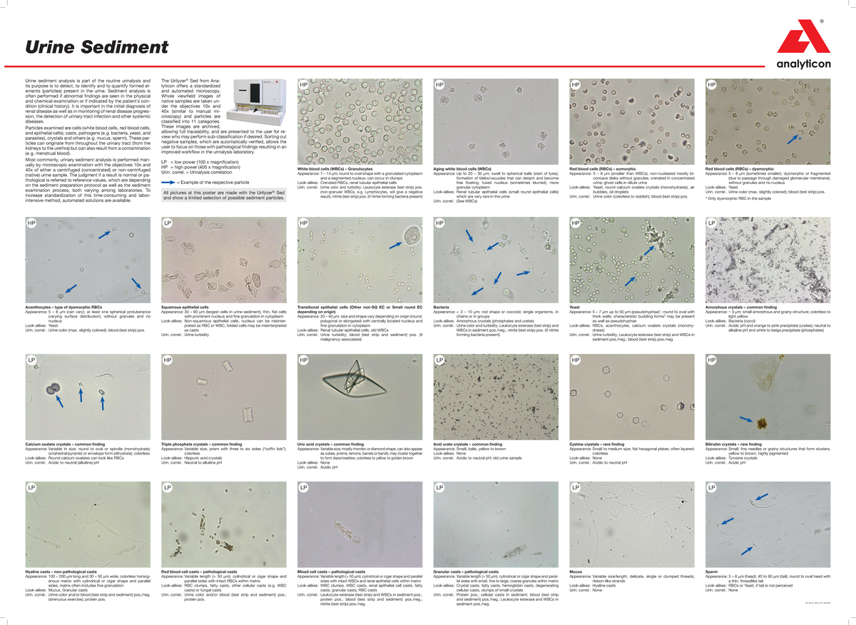 Urine sediment. - Urine Sediment Calcium oxalate crystals – common ...