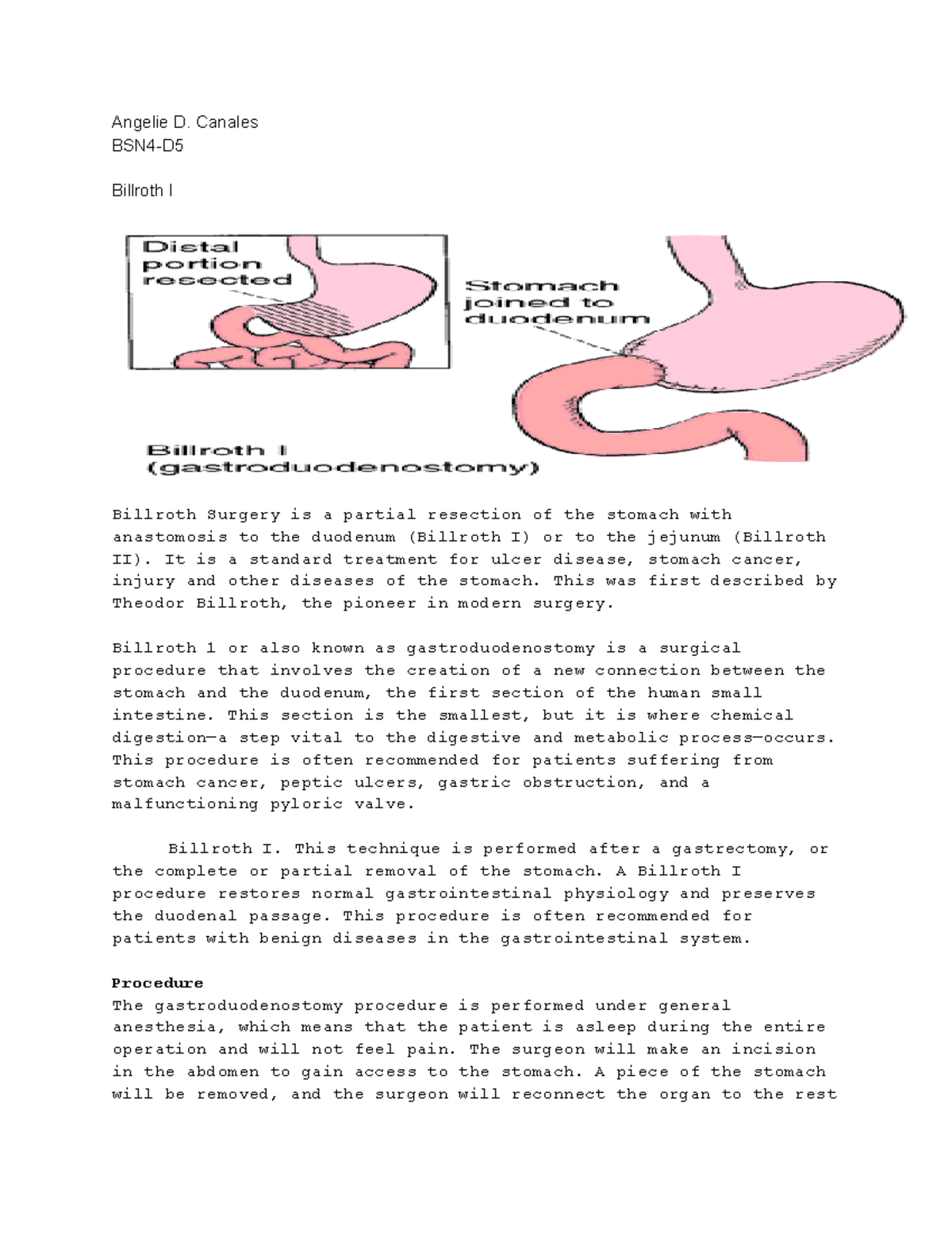 Billroth II - REVIEWERS - Angelie D. Canales BSN4-D Billroth I Billroth ...