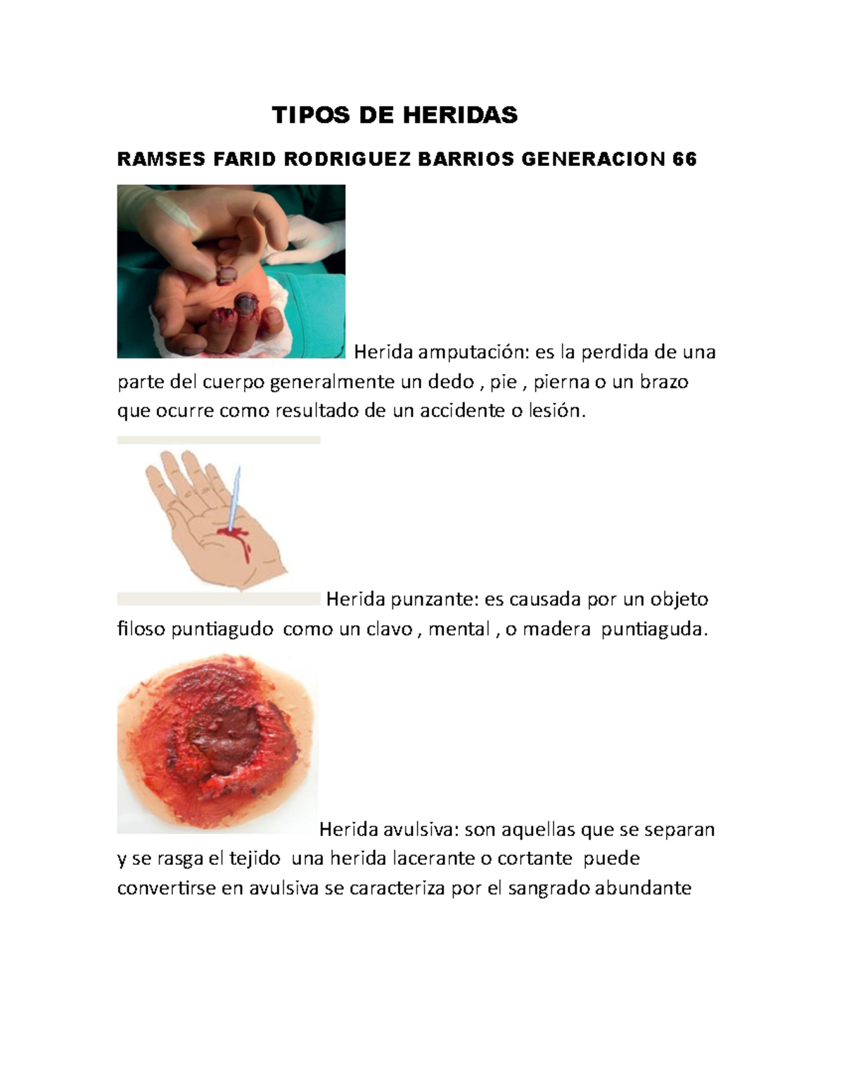 Tipos DE Heridass - Kua - TIPOS DE HERIDAS RAMSES FARID RODRIGUEZ ...