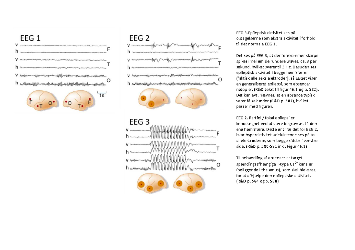 Epilepsi - EEG 3 aktivitet ses på optagelserne som ekstra aktivitet i ...