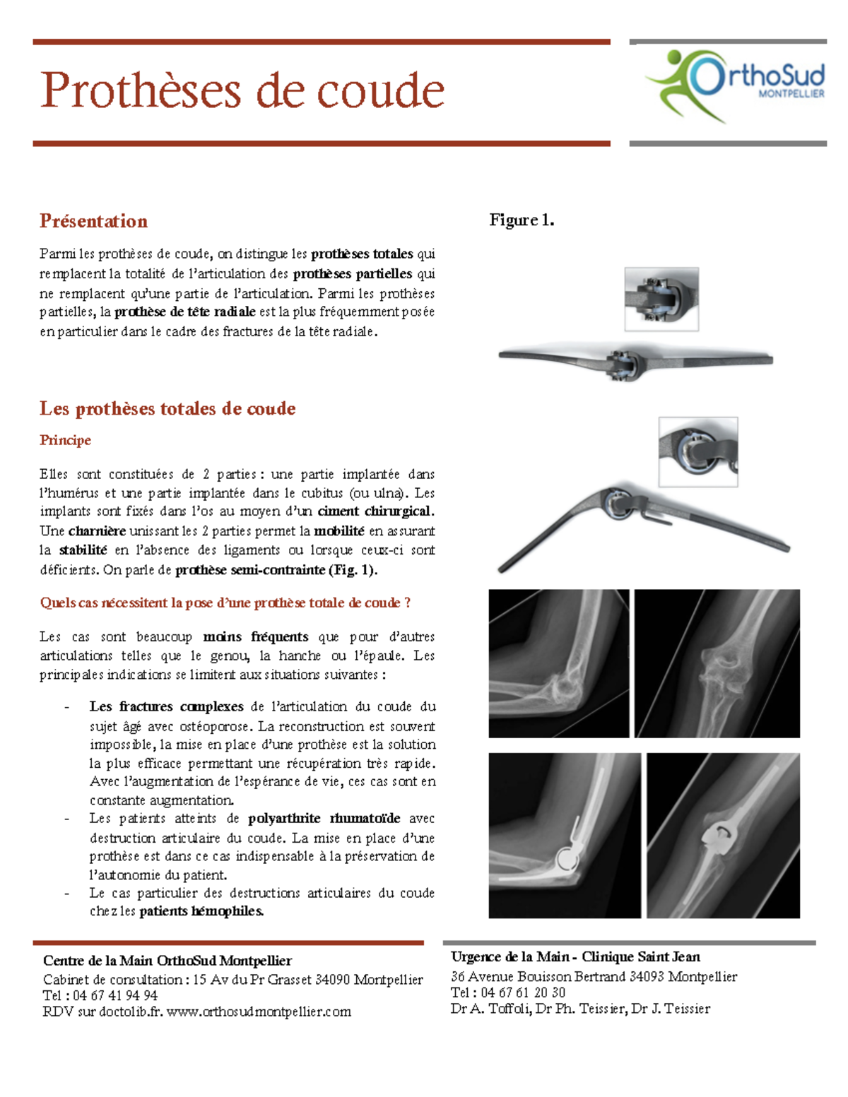 Protheses-de-coude - Referentiel uncam fracture humerus utile - Urgence ...