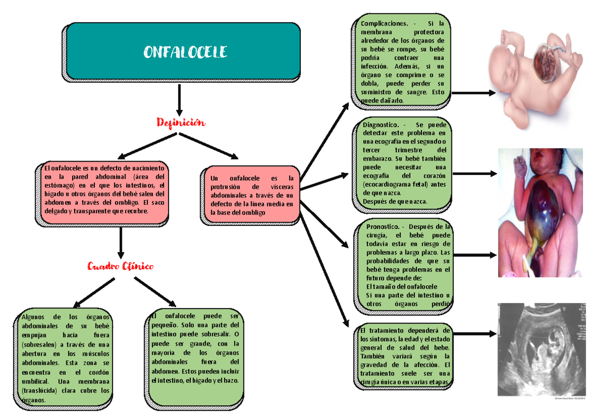 Onfalocele - ONFALOCELE El onfalocele es un defecto de nacimiento en la ...