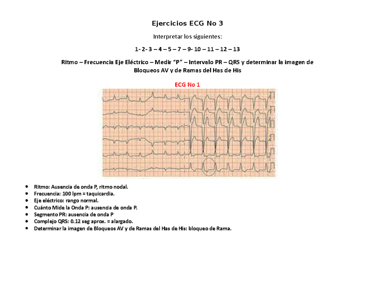 Tarea 3 y 4 ECG-1 - Trabajo ECG - ECG No 1 Ritmo: Ausencia de onda P ...
