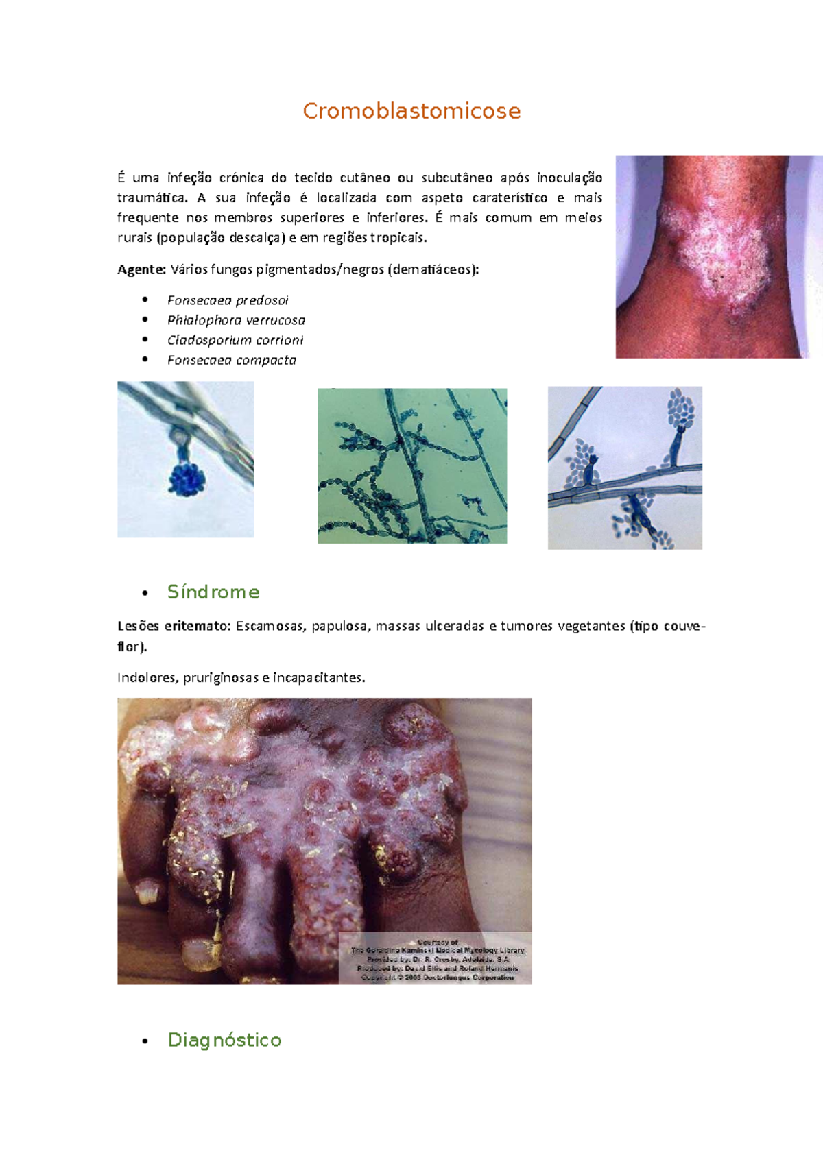 1-Micologia Cromoblastomicose - Cromoblastomicose É uma infeção crónica ...