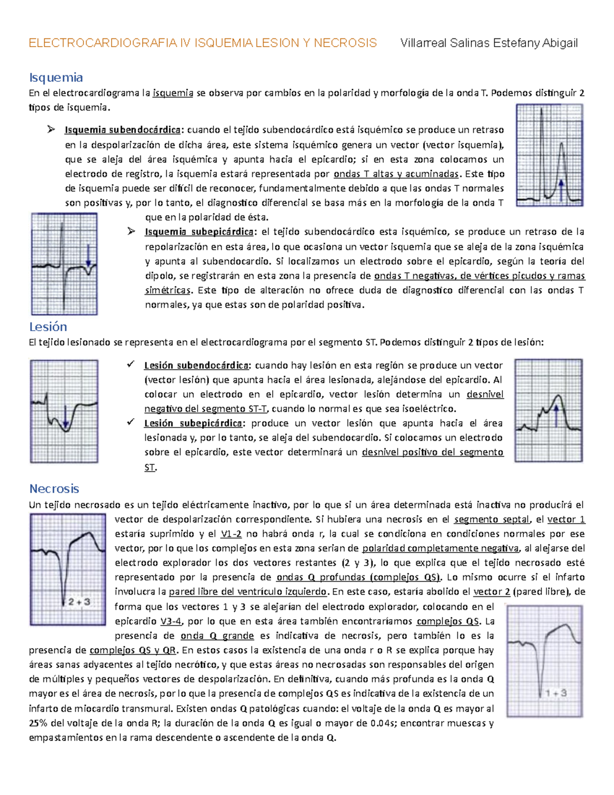 Electro 3 (isquemia, lesión, necrosis) - ELECTROCARDIOGRAFIA IV ...