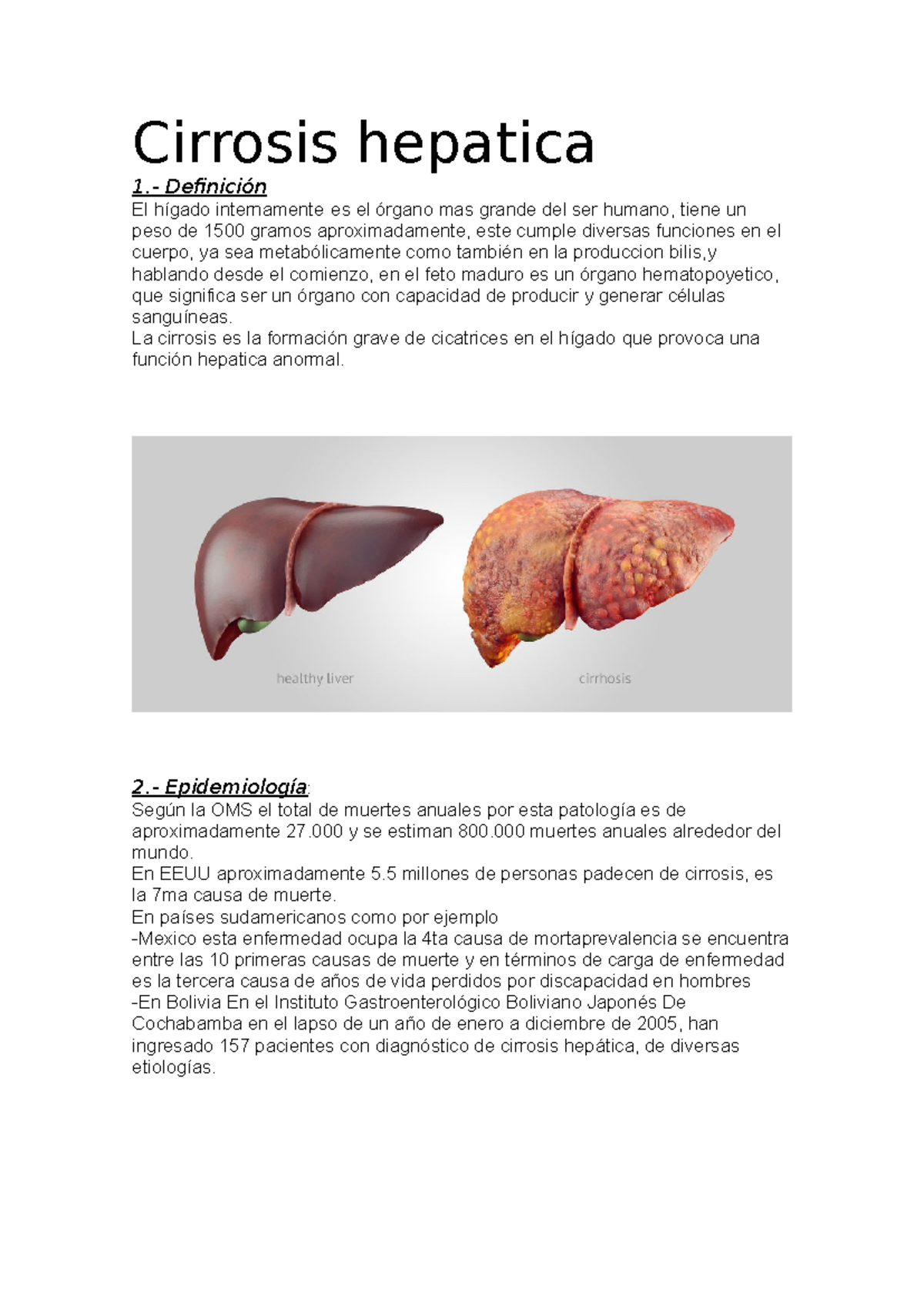 Cirrosis Hepatica - Cirrosis hepatica 1.- Definición El hígado internamente es el órgano mas ...