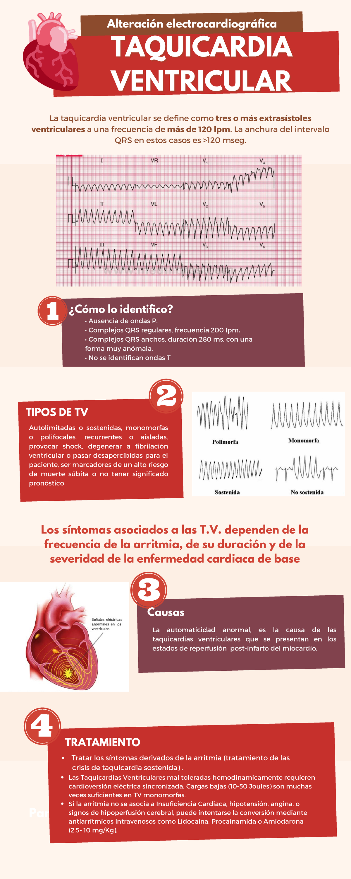Infografía TV - Alteracion electrocardiográfica - Autolimitadas o ...
