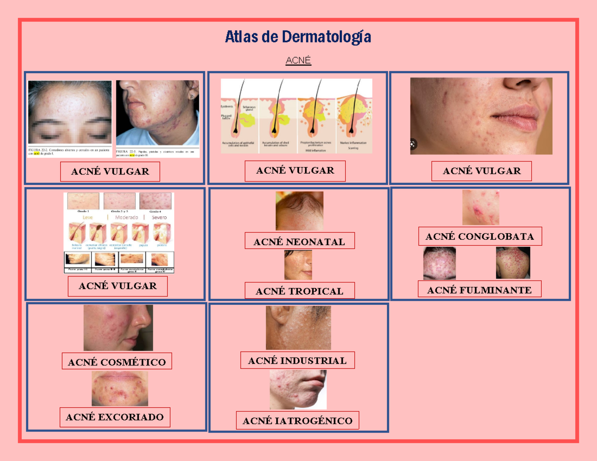 Atlas de Dermatología ACNÉ - Atlas de Dermatología ACNÉ ACNÉ VULGAR ...