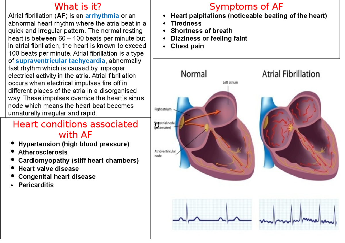 Atrial fibrillation - The normal resting heart is between 60 100 beats ...