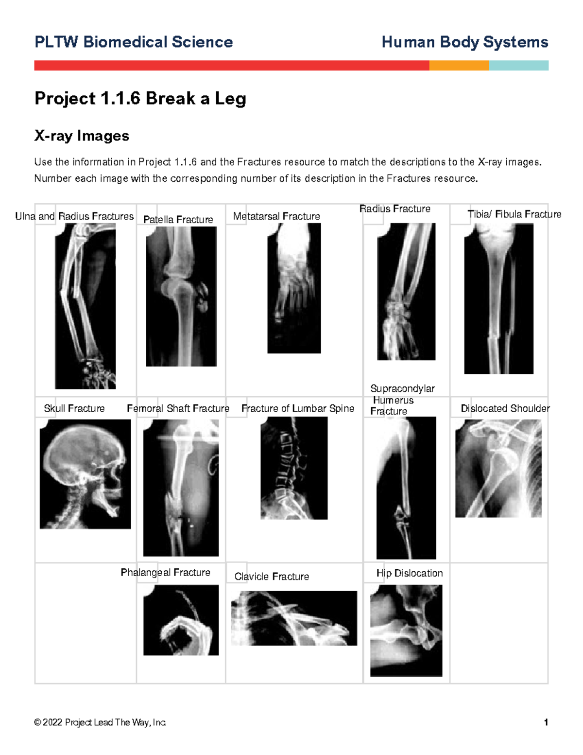 1.1.6 X-ray images Rithika - PLTW Biomedical Science Human Body Systems ...