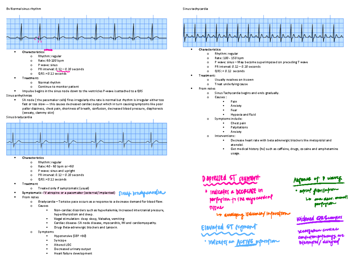 Cardiac Arrhythmias: Sinus Tachycardia Sinus Bradycardia Atrial Flutter ...