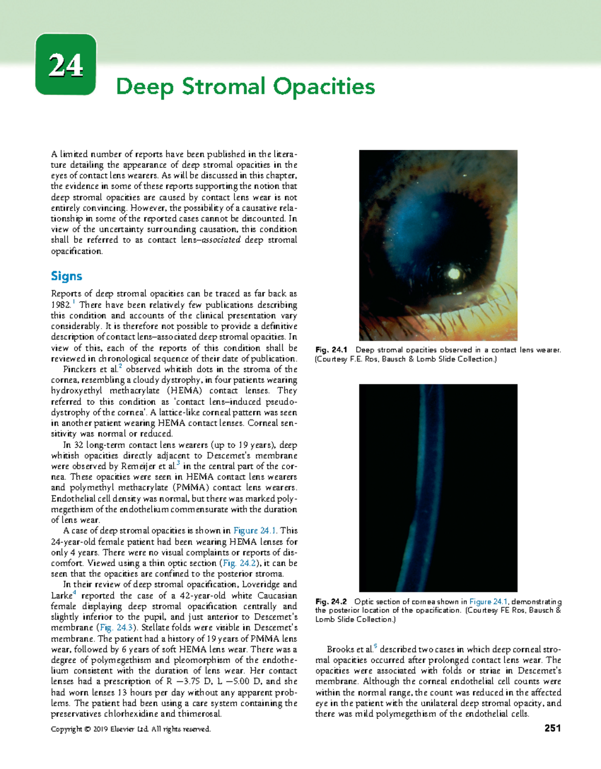 Deep Stromal Opacities Contact Lens Complications - 2424 Deep Stromal ...