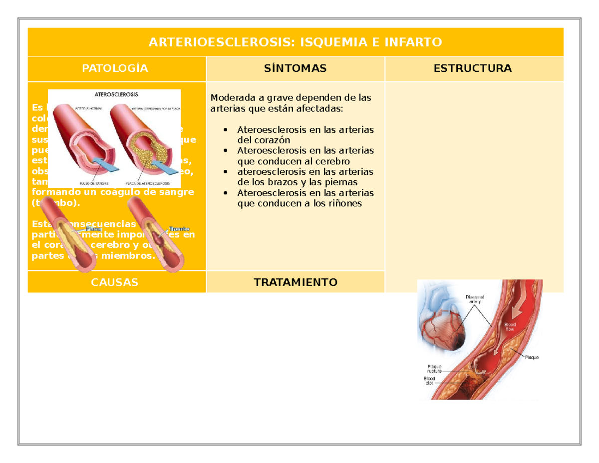 Sistema Cardiovascular - ARTERIOESCLEROSIS: ISQUEMIA E INFARTO ...